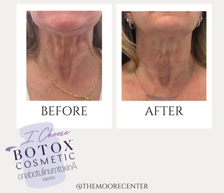 What is the Nefertiti Lift ? Botox Treatment for Jawline & Neck