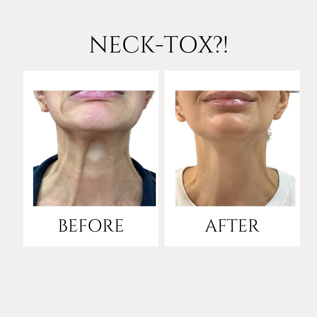What is the Nefertiti Lift ? Botox Treatment for Jawline & Neck